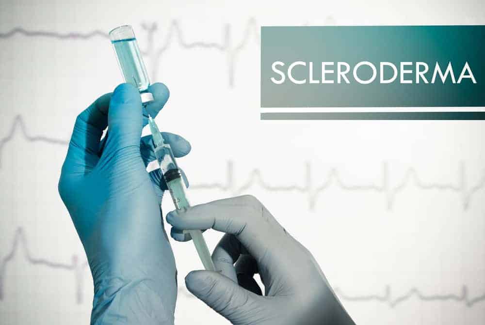 Scleroderma study: Hope for a longer life for patients with rare ...