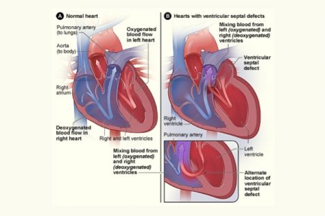 Congenital heart defects vastly increase risk of heart problems later ...