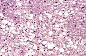 Dietary fiber supplement shows potential in treating fatty liver ...